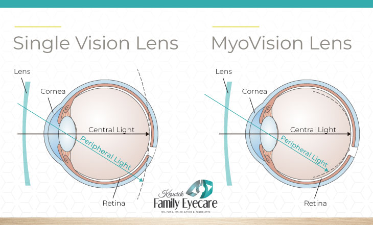 How Zeiss MyoVision Lenses Can Help Protect Kids From Myopia ...