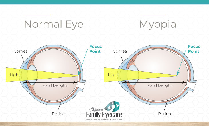 How Zeiss MyoVision Lenses Can Help Protect Kids From Myopia ...